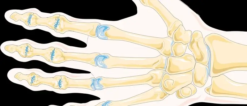 Low-Carb und Arthrose - Faszientherapie in Quedlinburg